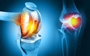 Knee Replacement in Madurai - TORC